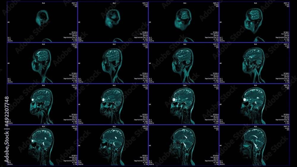 Magnetic resonance images of the brain (MRI brain), 16x1 split screen sagittal plane axial view ...