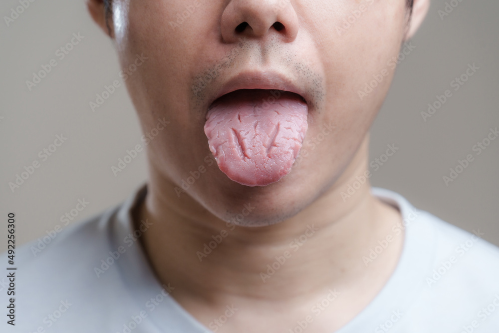 A man sticking out Fissured tongue, Bacterial infection disease tongue ...