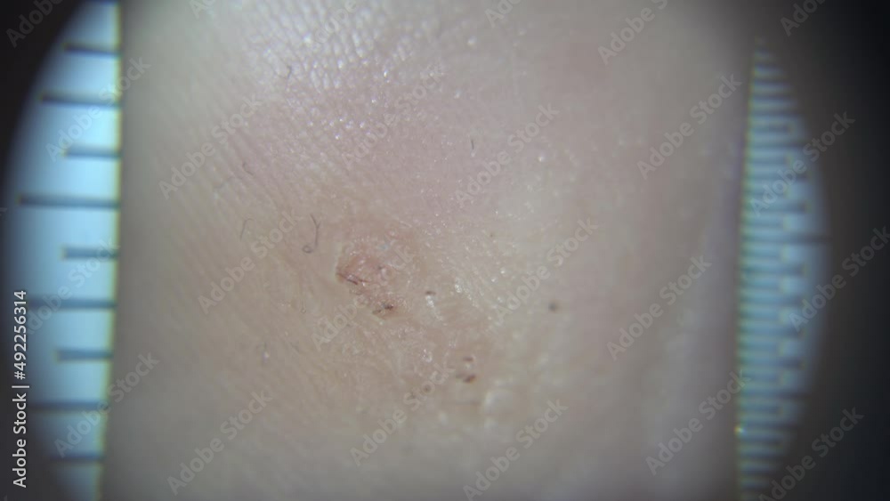 An electron microscope zooms in on a wart on a girl's leg in a ...