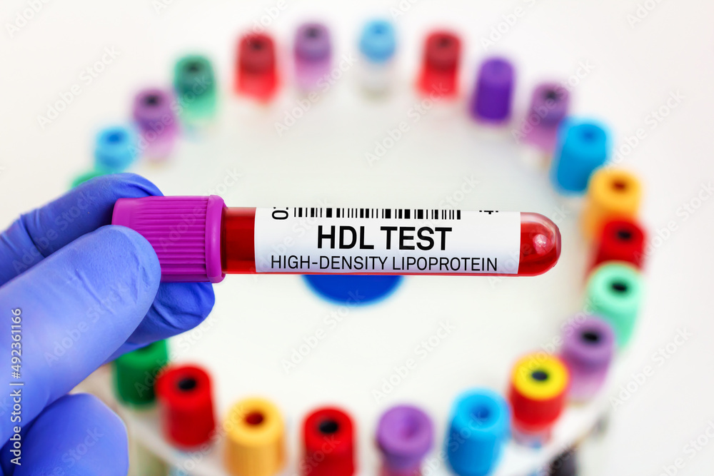 doctor with Blood tube for HDL High Density Lipoprotein test for ...