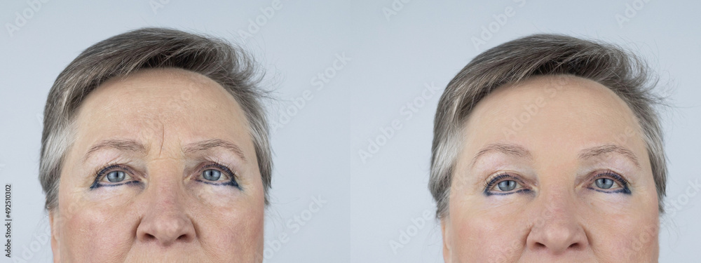 Foto de Forehead wrinkle. Photos before and after mesotherapy ...
