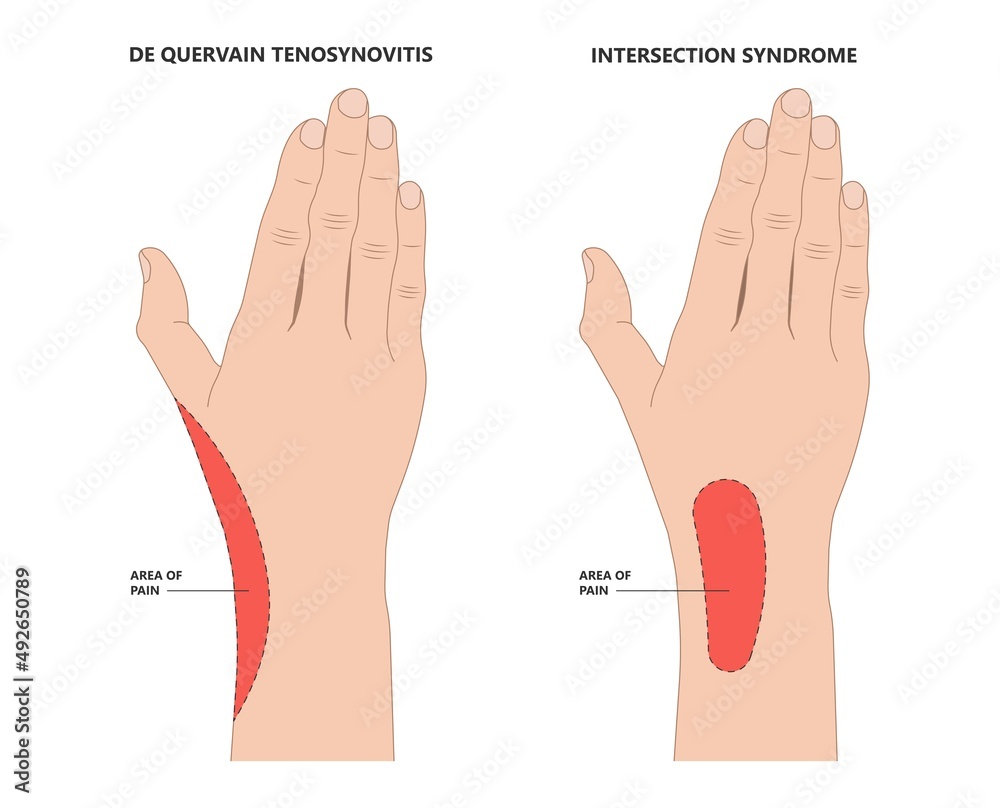 De quervain's pain tendon thumb wrist hurt grasp make a fist sport ...