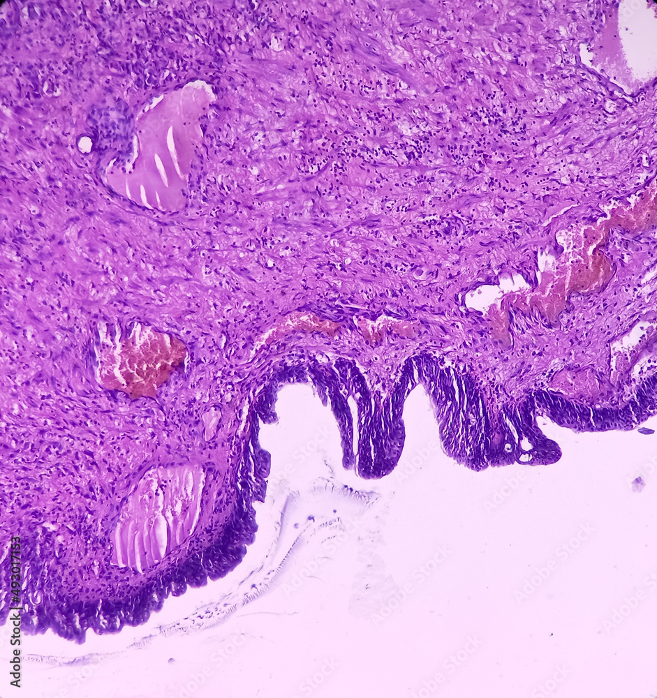 Prostate Cancer(TURP): Microscopic image of prostatic tissue ...