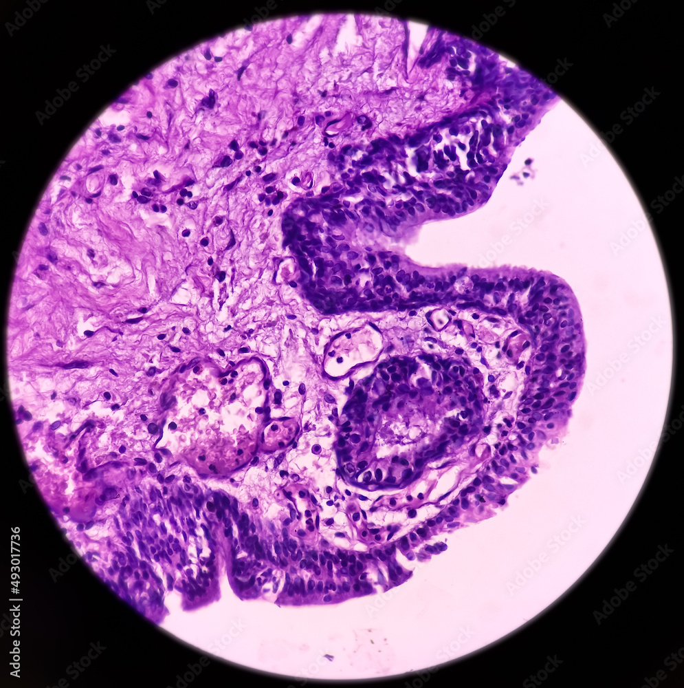 Prostate Cancer(TURP): Microscopic image of prostatic tissue ...