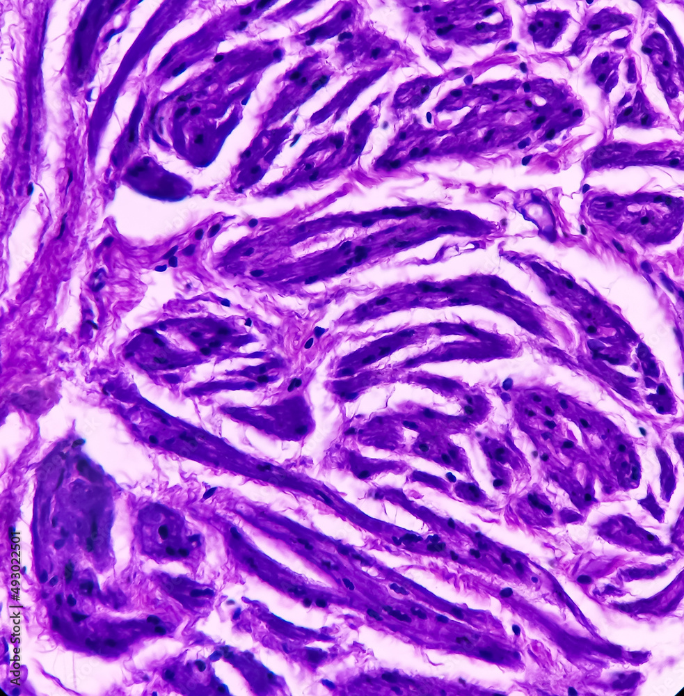 Prostate histology(TURP): Photomicrograph of biopsy of prostate gland ...