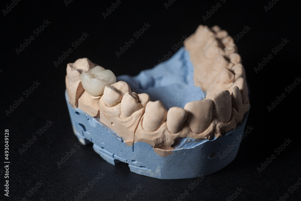 Mold of teeth. Gypsum model plaster of teeth. Stomatologic plaster cast ...