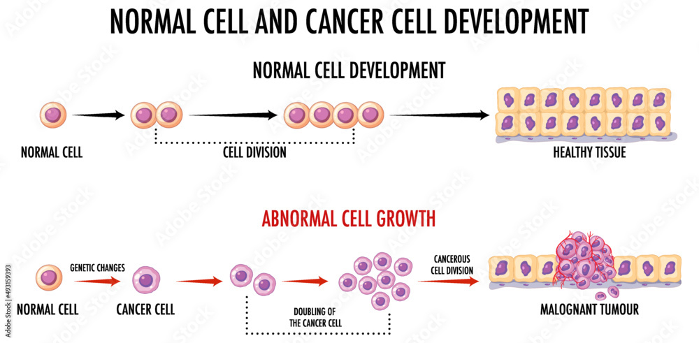 Diagram showing normal and cancer cells Stock Vector | Adobe Stock