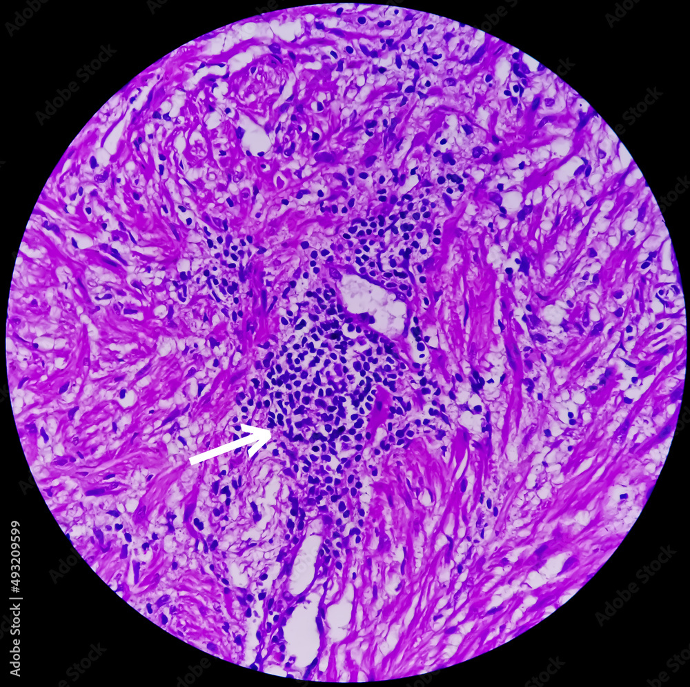 Prostate Cancer (TURP): Microscopic image of prostatic tissue ...