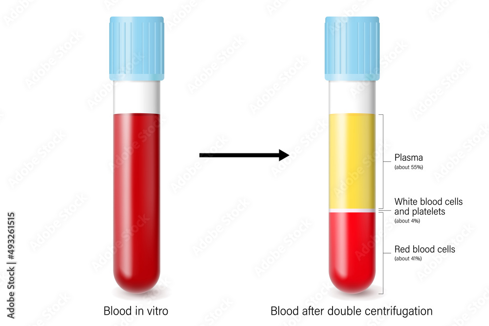 Blood in vitro and blood after double centrifugation. Plasma, red blood ...