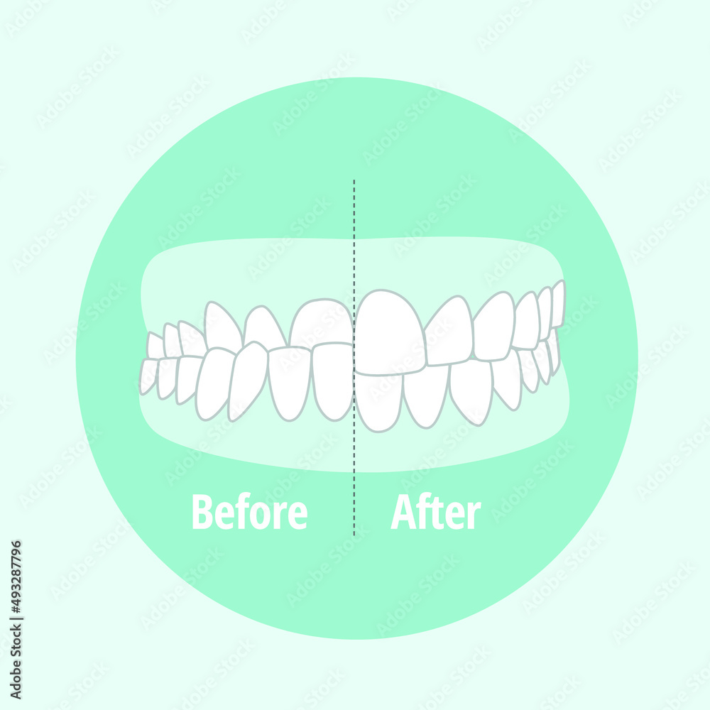Malocclusion Underbite. Dental problem vector illustration. Dental care ...