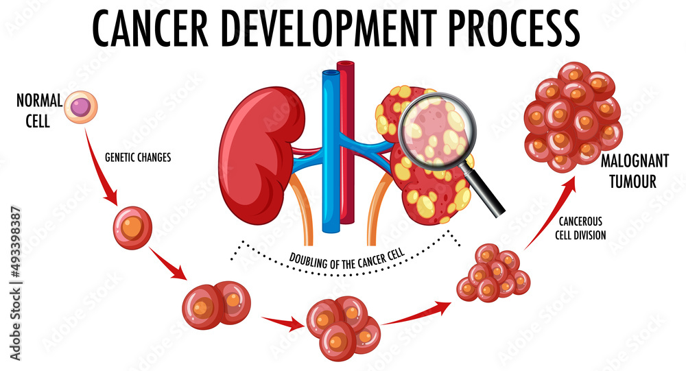 Diagram showing cancer development process Stock Vector | Adobe Stock