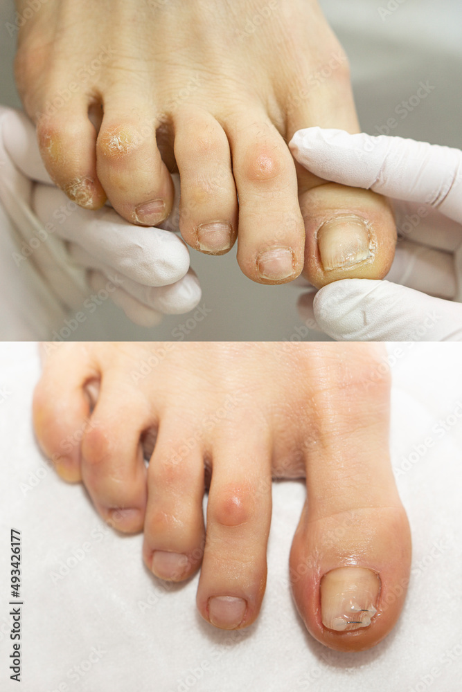 Collage. toes before and after the pedicure procedure with the ...