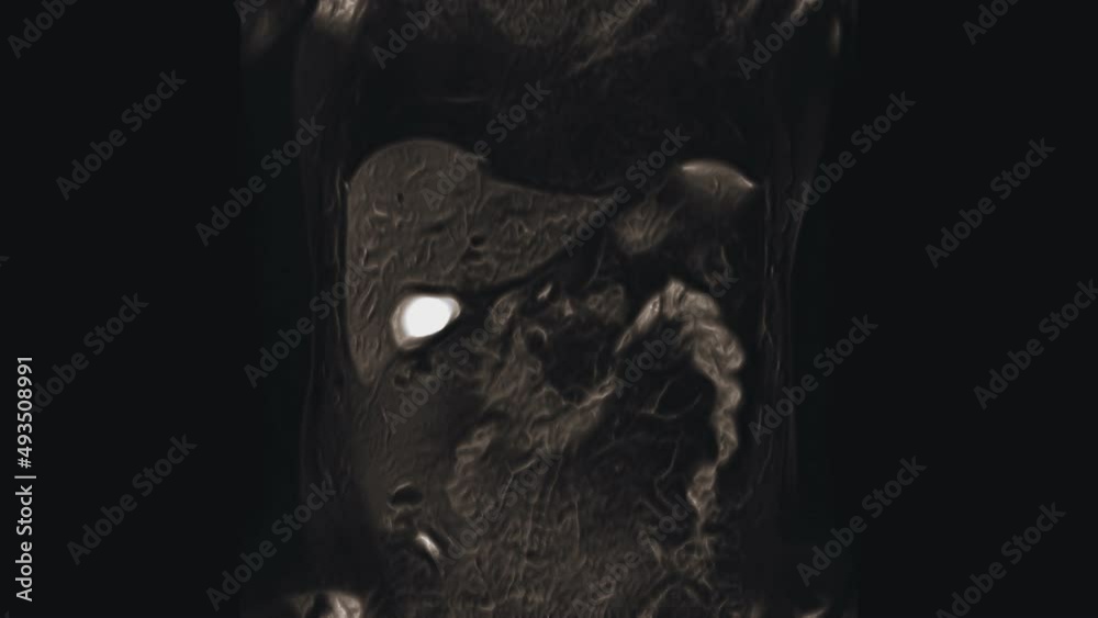 Voluminous color CT scan of the abdomen. Computed tomography of the ...