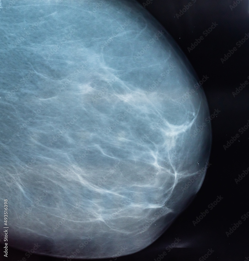 X-rays Digital mammography; a method of x-raying a woman's breast for ...