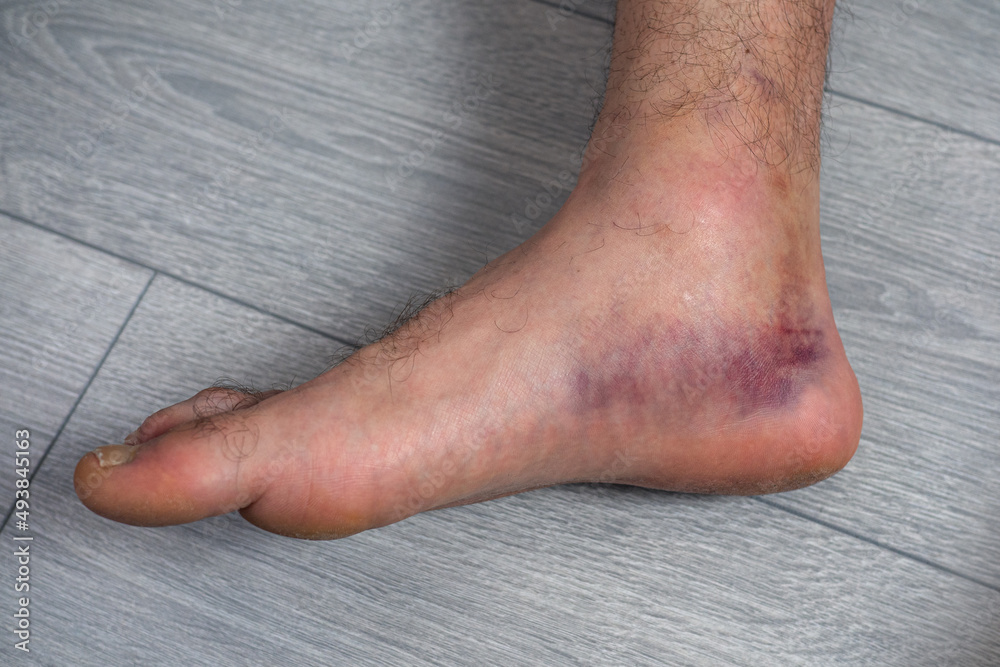Ankle injury with dislocation and sprains. Fracture or Leg sprain ...