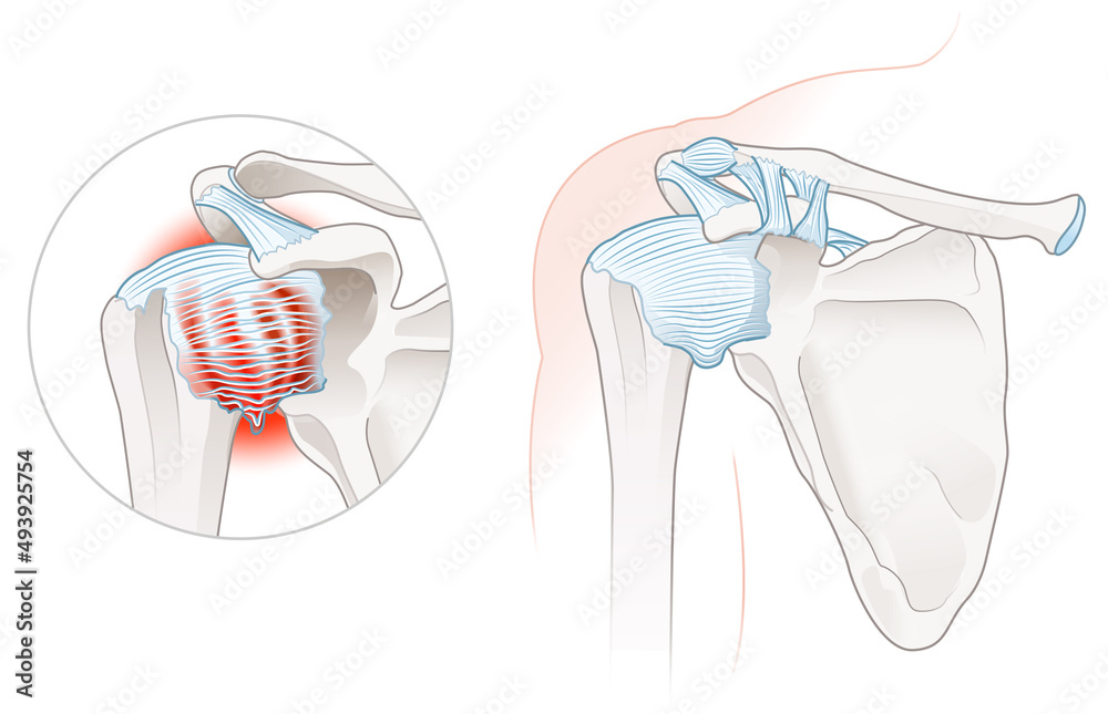 Frozen Shoulder Adhesive capsulitis Illustration. Labeled Stock ...