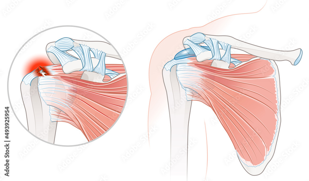 Rotator Cuff Tear Shoulder Illustration Stock Illustration | Adobe Stock