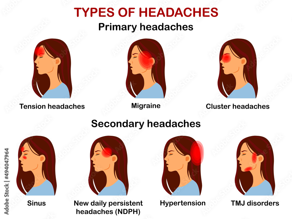 Types of headaches. Vector Infographic. Stock Vector | Adobe Stock Types of headaches. Vector Infographic. Stock Vector | Adobe Stock