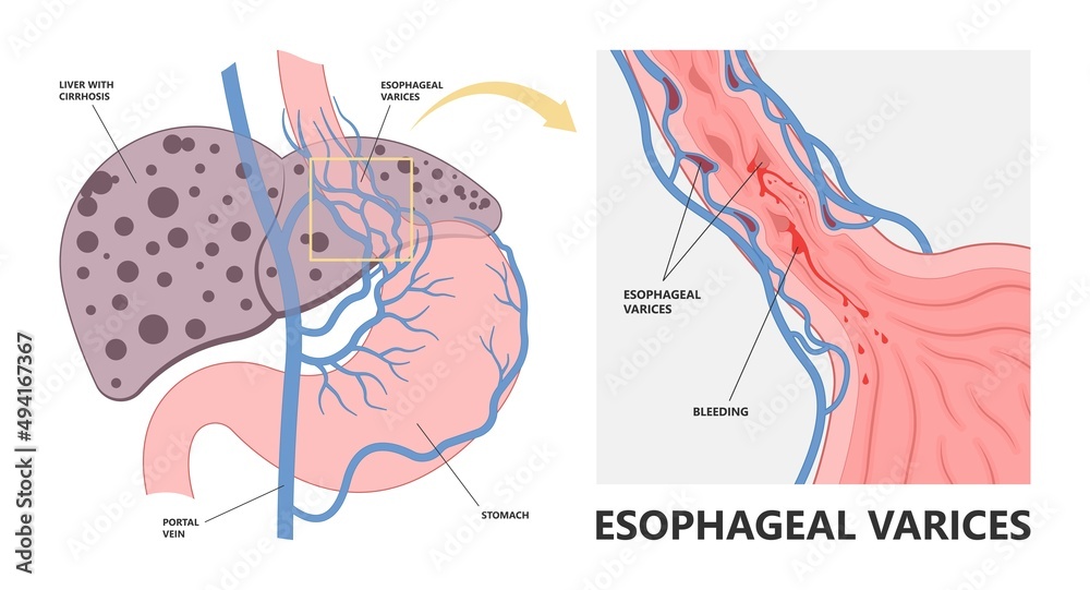 Weiss tear upper gastric ulcer portal liver veins clot blood stools ...