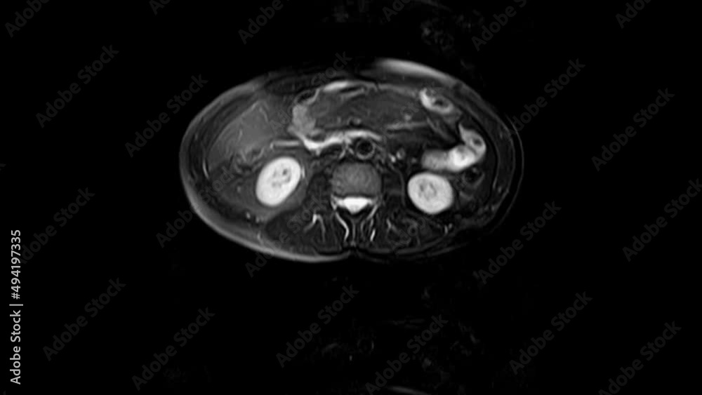 CT scan of the abdomen. Computed tomography of the gastrointestinal ...