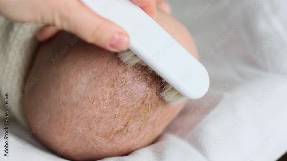removing dandruff flakes of seborrhea from baby infant head with soft ...