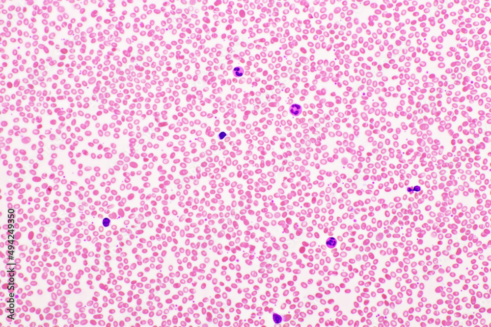 Red blood cells and white blood cells in blood smear, Wright-Giemsa ...