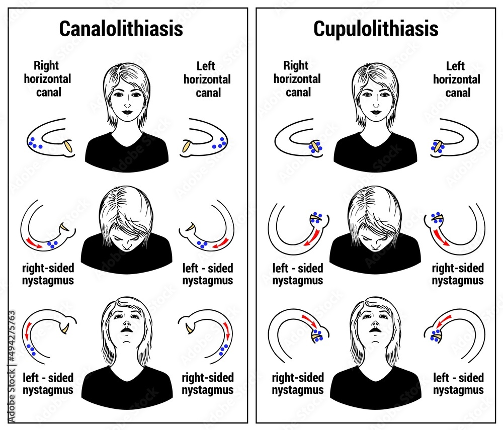 benign paroxysmal positional vertigo canalolithiasis cupulolithiasis ...