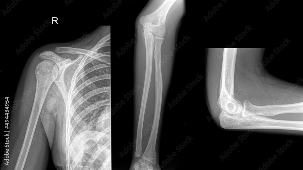 X ray of a arm, forearm and elbow. Stock Photo | Adobe Stock