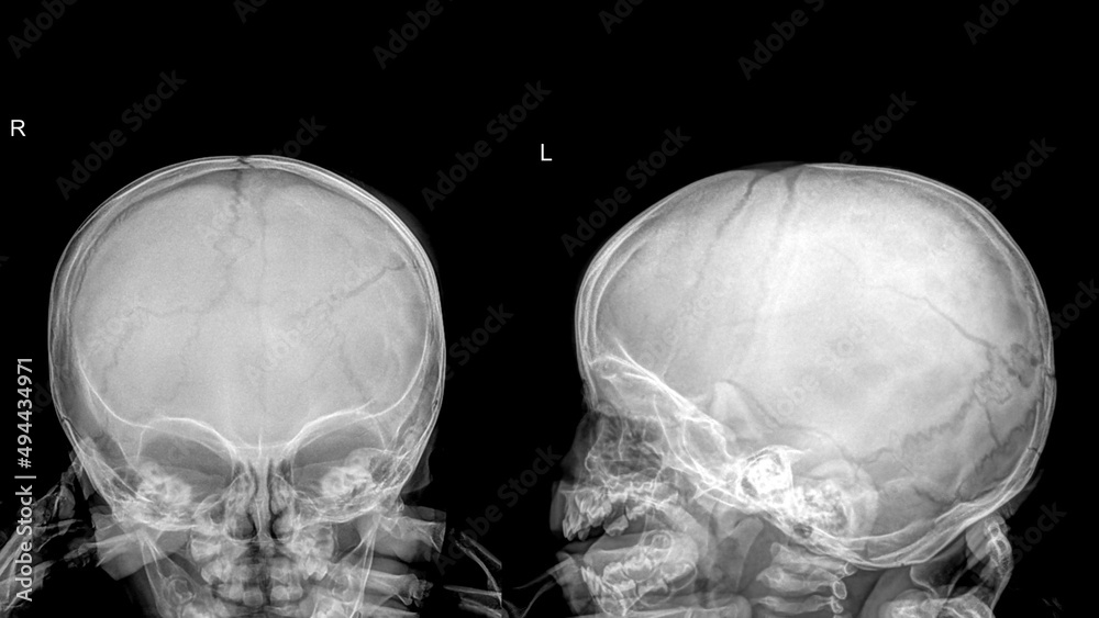 skull x-ray with a linear fracture of a left parietal bone. Stock Photo ...