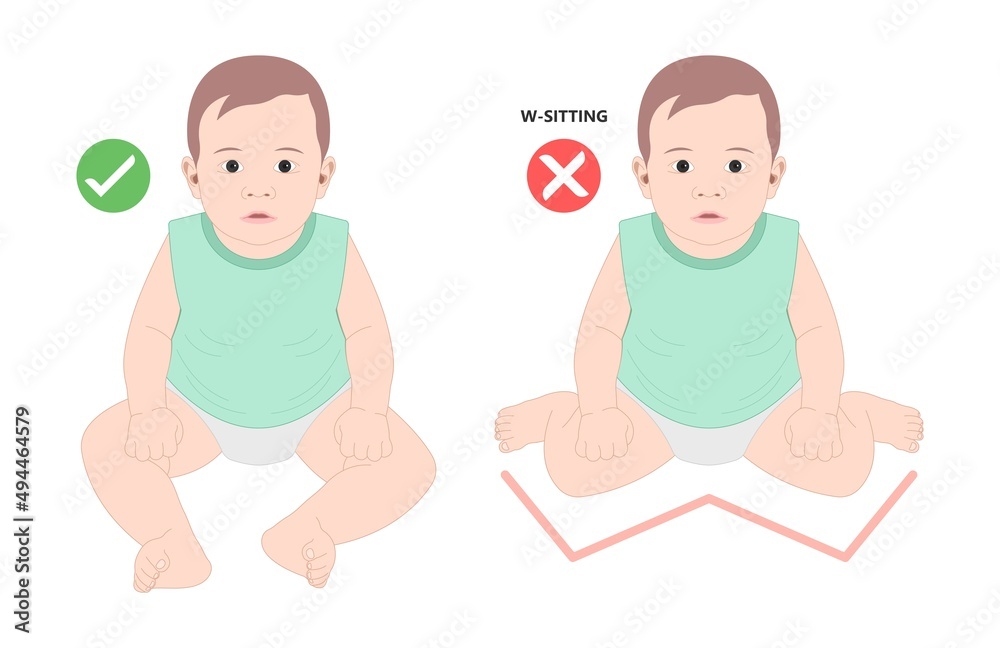 Birth infant genu valgum varum criss cross and club foot tailor body ...