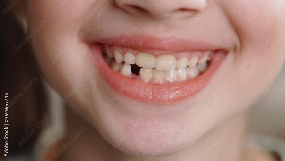 Close-up mouth child has lost one milk teeth. Replacement of permanent ...