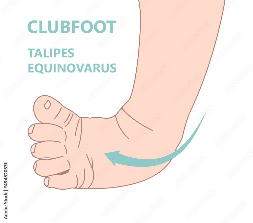 Newborn Foot Turned Inward at Micheal Weston blog