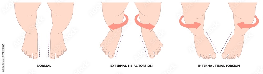 Disorders W sit injury bow leg genu valgum varum flat duck out turn ...