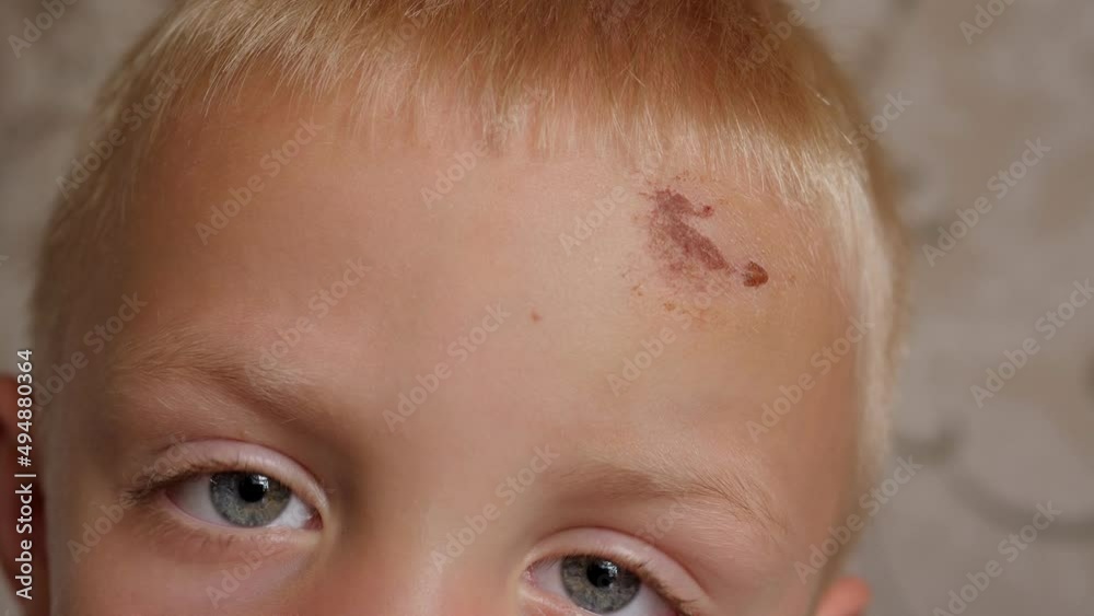 Close-up of a scratch and a bump on the forehead of a small boy. The ...