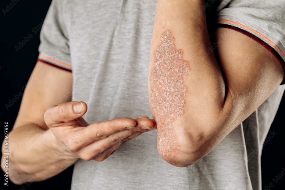 Acute psoriasis on the elbows is an autoimmune incurable dermatological ...