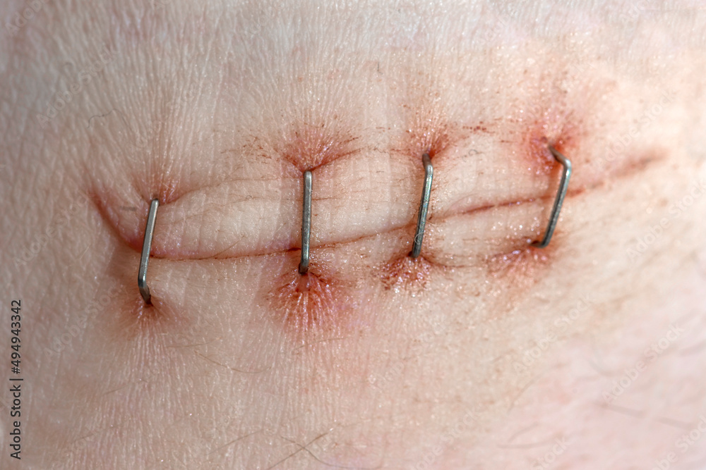 Foto De Surgical Staples For Sutures To Close Skin First Aid For A Foto De Surgical Staples For Sutures To Close Skin First Aid For A