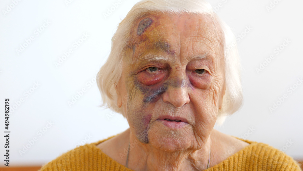 Old woman with bruises on the face. Bruises caused by dizziness, falling over and hitting with ...