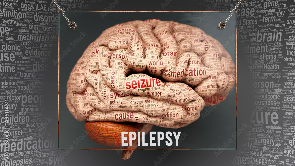 Epilepsy anatomy - its causes and effects projected on a human brain ...