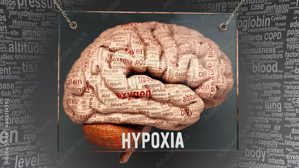 Hypoxia anatomy - its causes and effects projected on a human brain ...