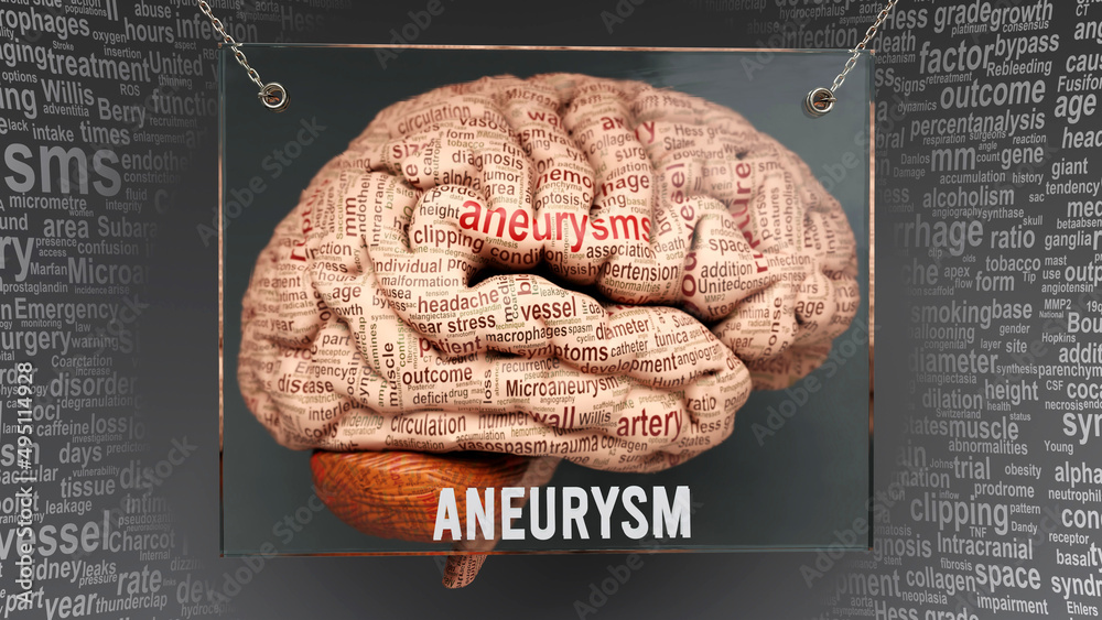 Aneurysm anatomy - its causes and effects projected on a human brain revealing Aneurysm ...
