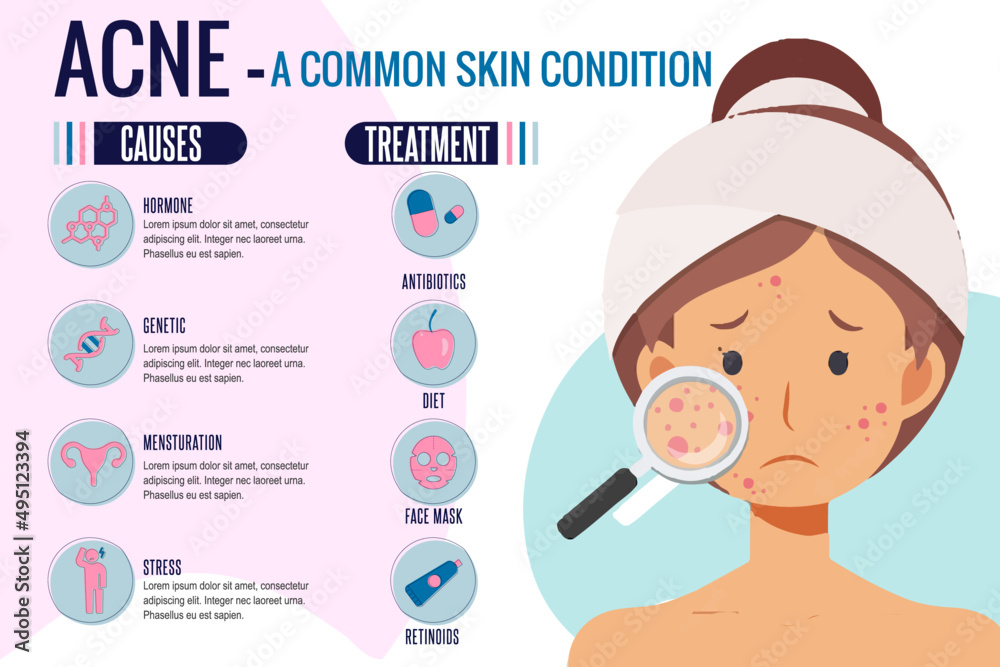 Acne causes and treatment skin problems infographics templet Stock ...