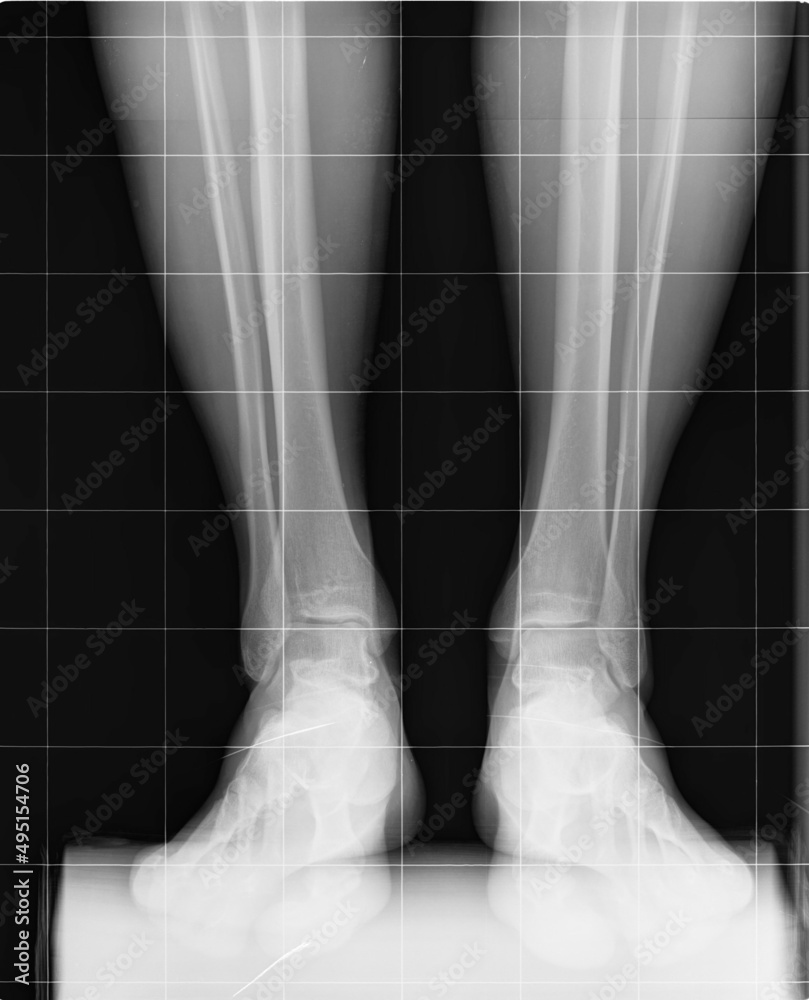 Radiografia piernas RX Stock Photo | Adobe Stock