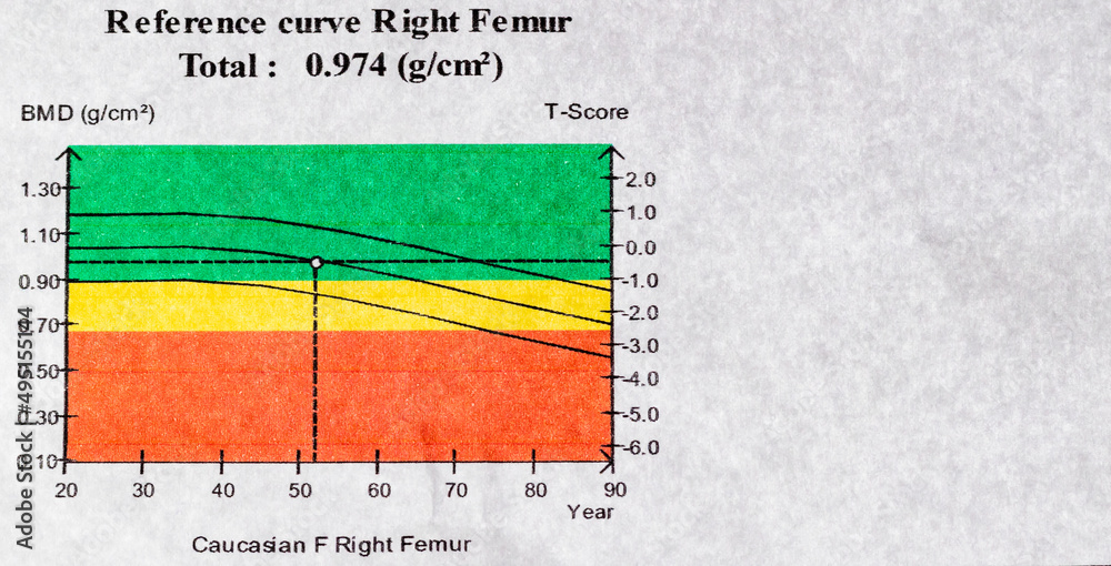 Close-up photo showing a graph, diagram, and curve of bone mineral ...