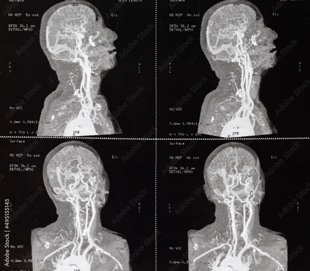 Close-up photo of a contrast-enhanced MRI of the skull and cerebral ...