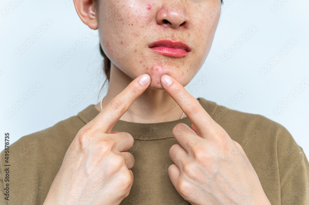 Cropped shot of woman pointing to acne occur on her lower face ...