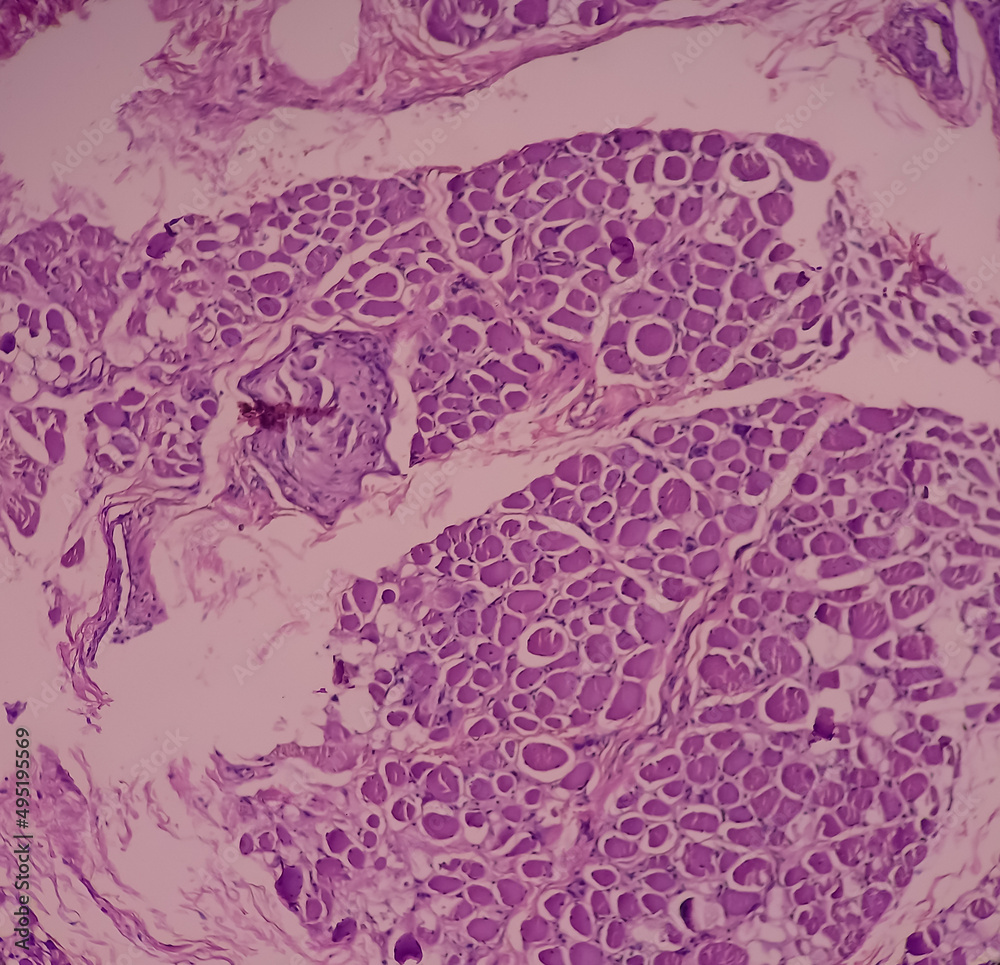 Fistula tract(biopsy): Fistulous tract lined by granulation tissue with ...