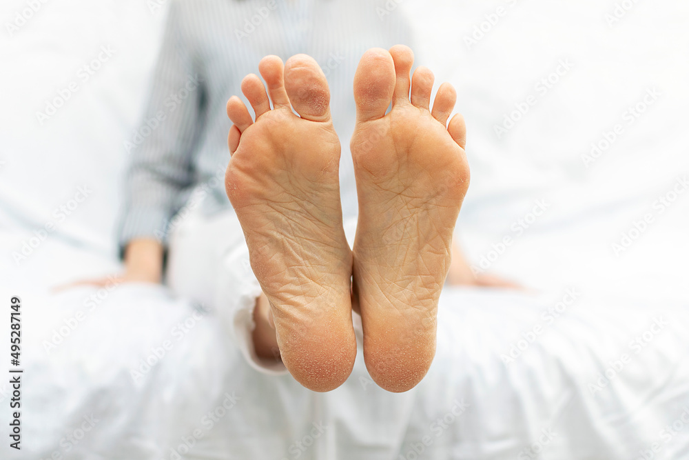 Dry skin of feet, damaged cracked sole with scales and cracks ...