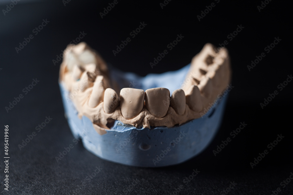 Mold of teeth. Gypsum model plaster of teeth. Stomatologic plaster cast ...