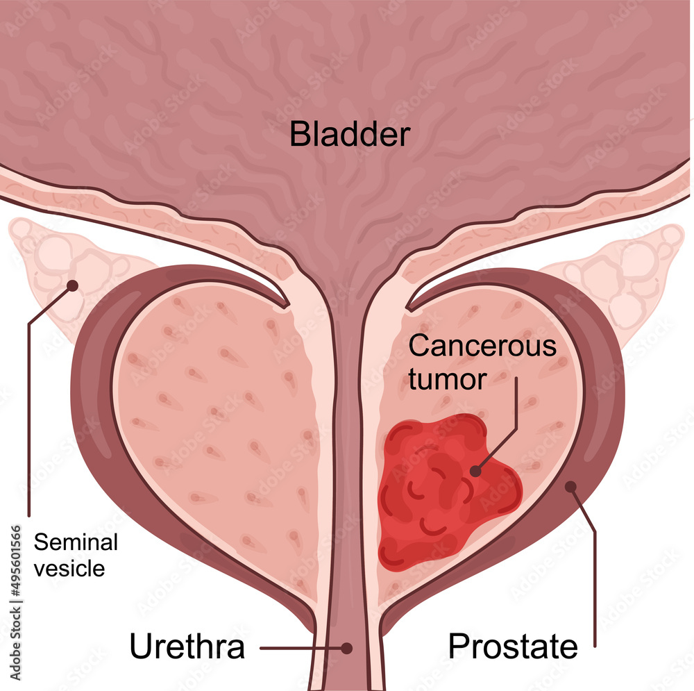 Medical diagram of 2 stages of prostate cancer. Stock Vector | Adobe Stock