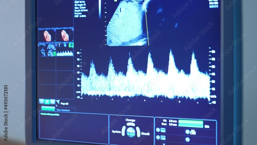 Screen of an ultrasound apparatus showing the inner of pregnant woman's ...